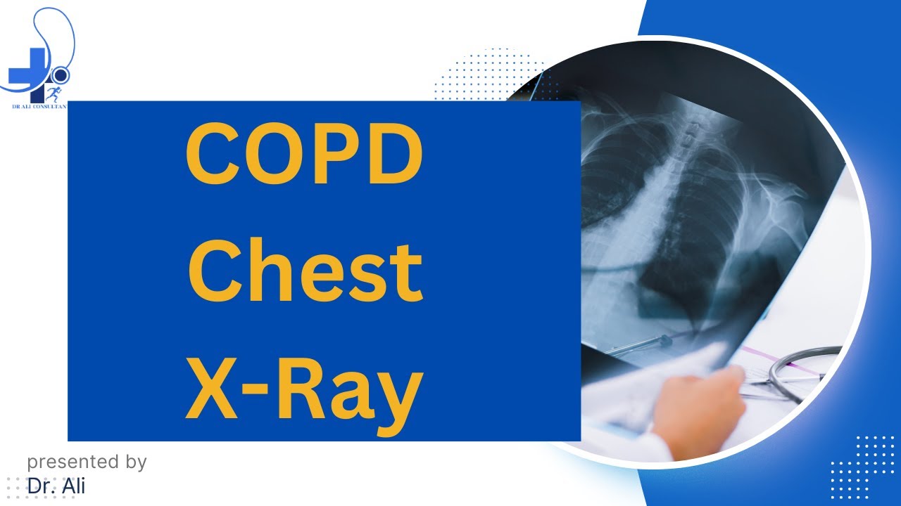 COPD X Ray Findings: Chronic Obstructive Pulmonary Disease X-Ray - YouTube