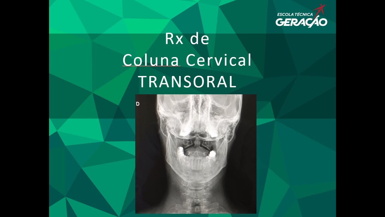 Radiografia da Coluna Cervical - Transoral - YouTube