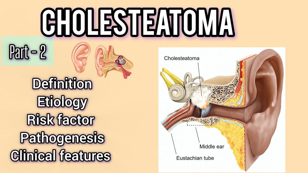 Disease of middle ear | Cholesteatoma part -2 - YouTube
