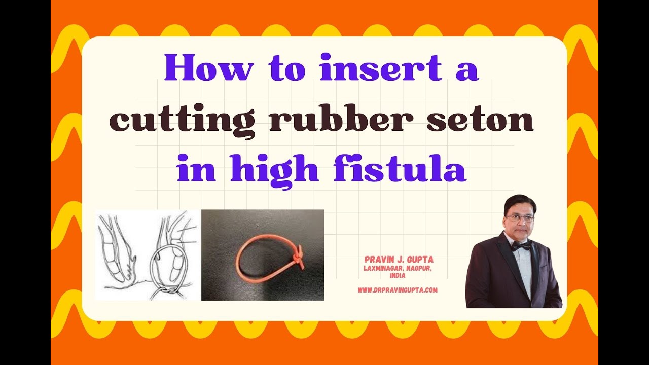 A CUTTING RUBBER SETON IN A HIGH FISTULA - YouTube