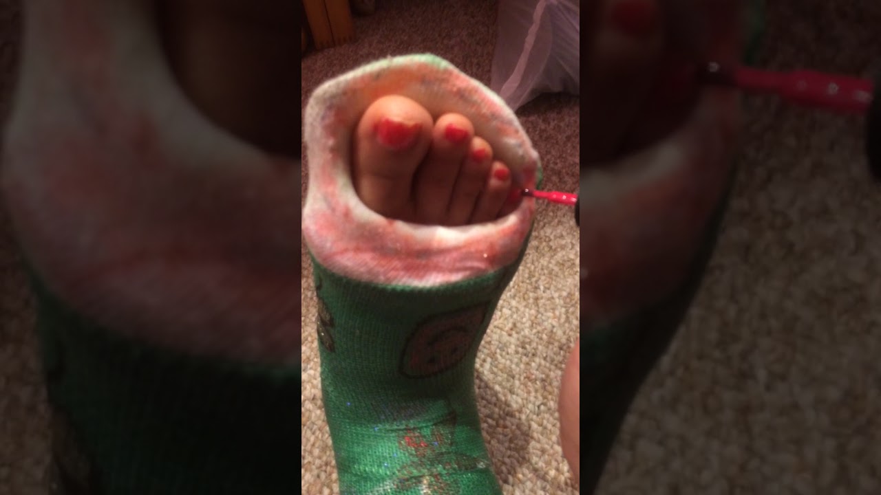 Painting toenails in leg cast- Nov 2019 - YouTube