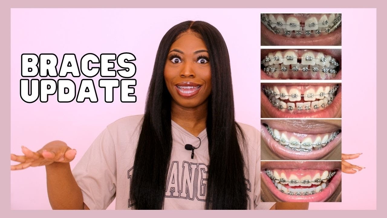 One Year Braces Update! - YouTube
