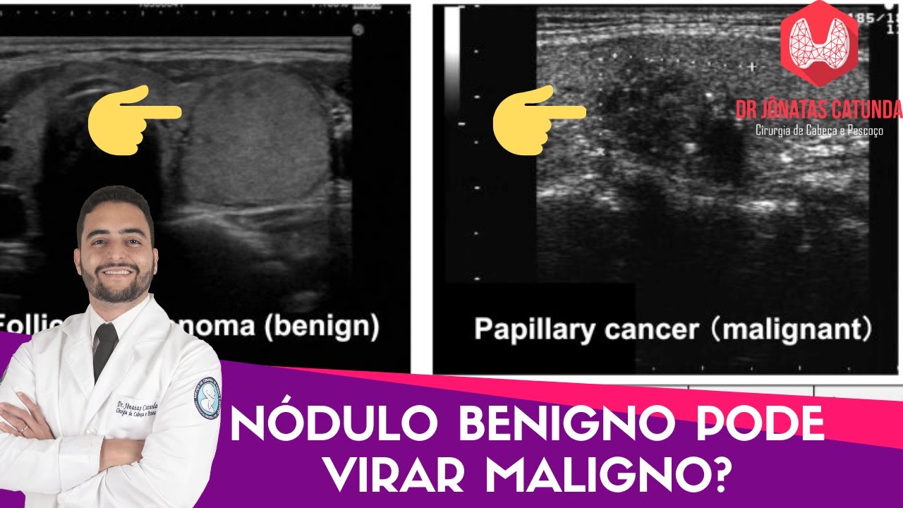 Nódulo na tireóide benigno pode virar maligno? - YouTube