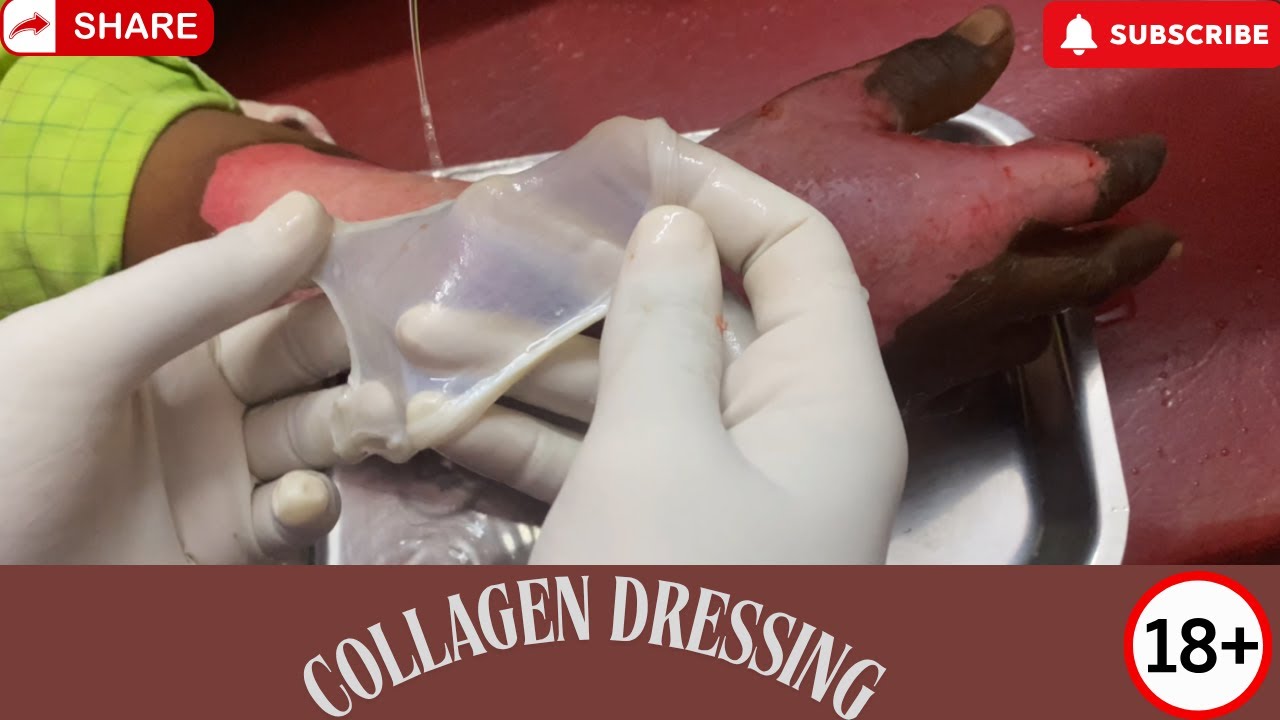 COLLAGEN SHEET DRESSING IN BURN #collagen - YouTube