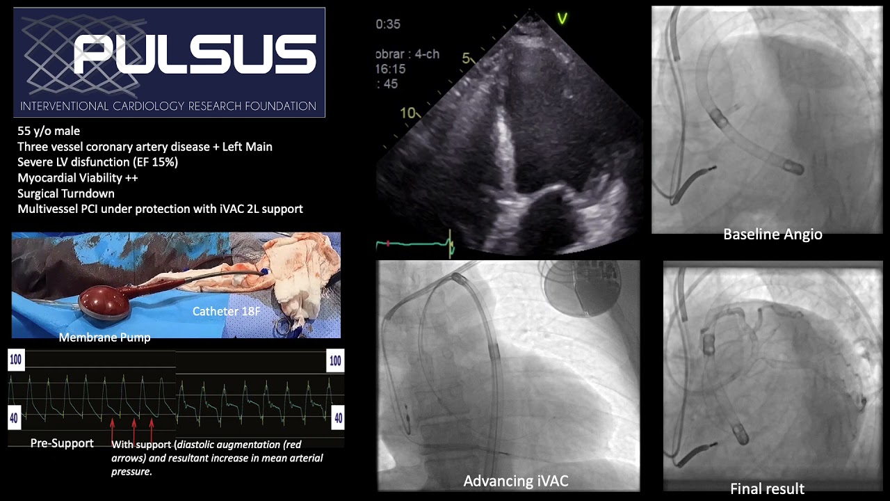 Pulsatile iVAC 2L circulatory support in high-risk percutaneous ...
