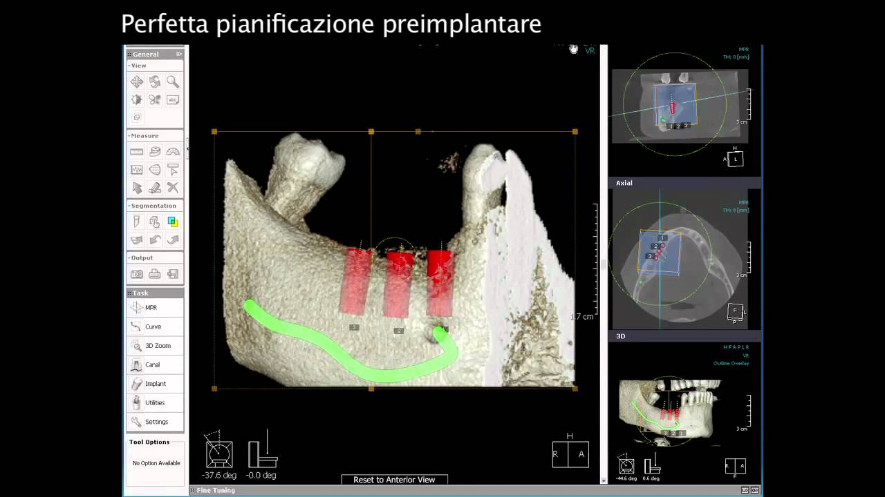 Cone Beam CT and 3D software - YouTube