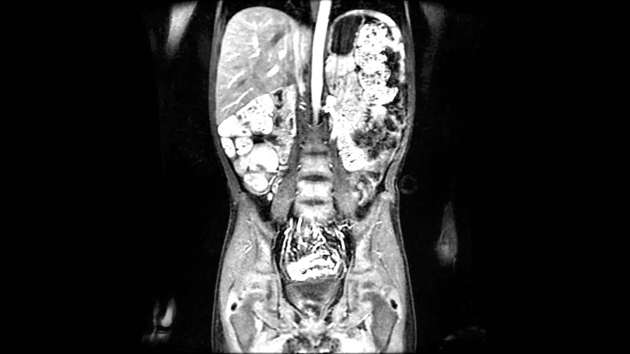 Contrast enhanced 3D T1 (LAVA FLEX) bowel MRI at 3.0 Tesla - YouTube