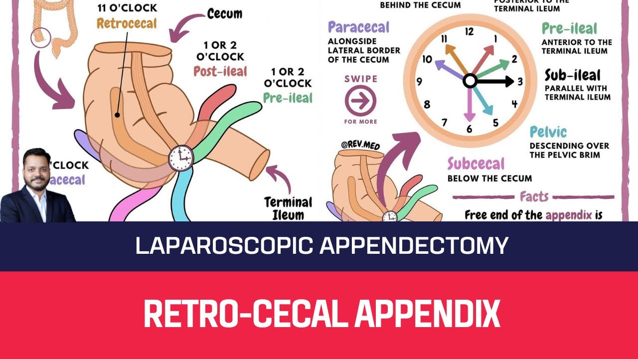 #124 : LAPAROSCOPIC APPENDICECTOMY IN A CASE OF RETROCECAL APENDIX ...