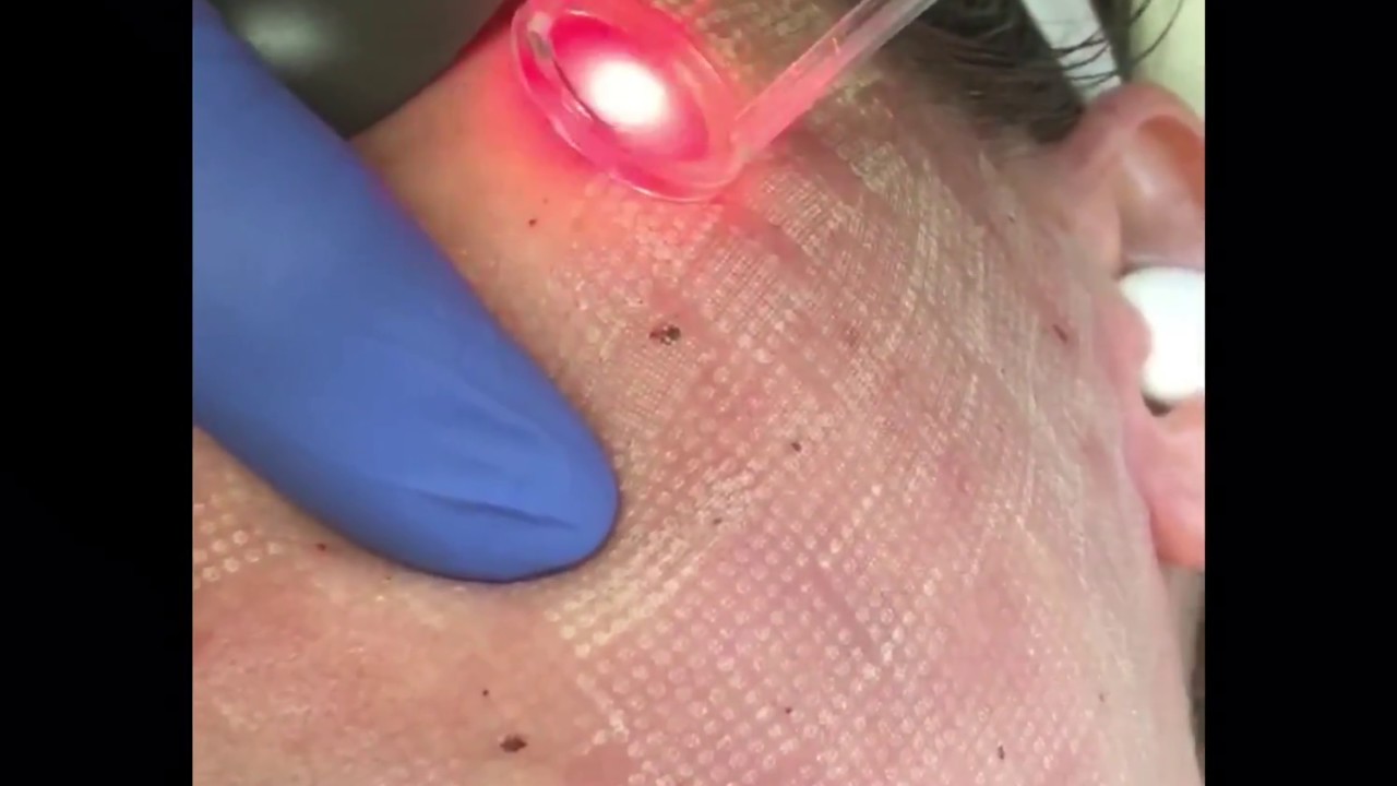 AcuPulse CO2 Laser! - YouTube