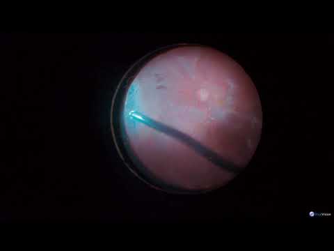 Retinal detachment with PVR - YouTube