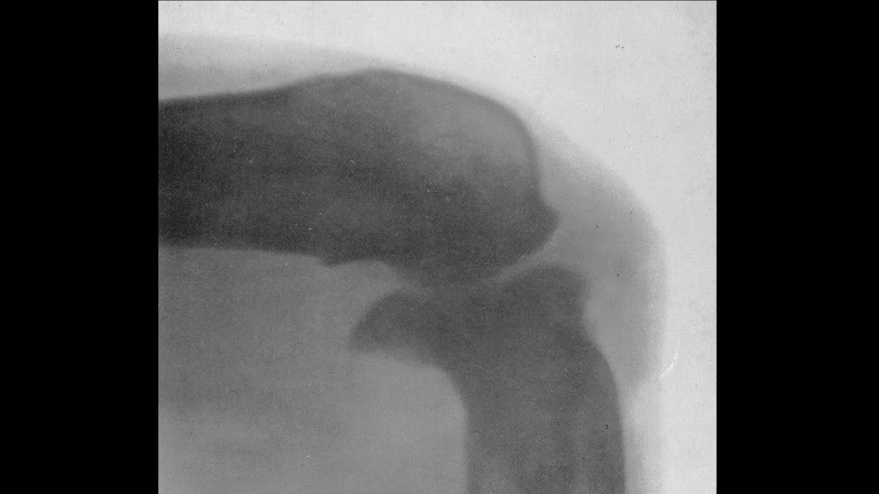 George Pirie and the Dundee X-Ray Pioneers - YouTube
