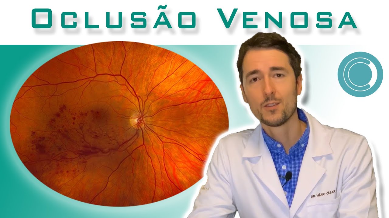Derrame no olho? Oclusão venosa da retina - sintomas e tratamento - YouTube