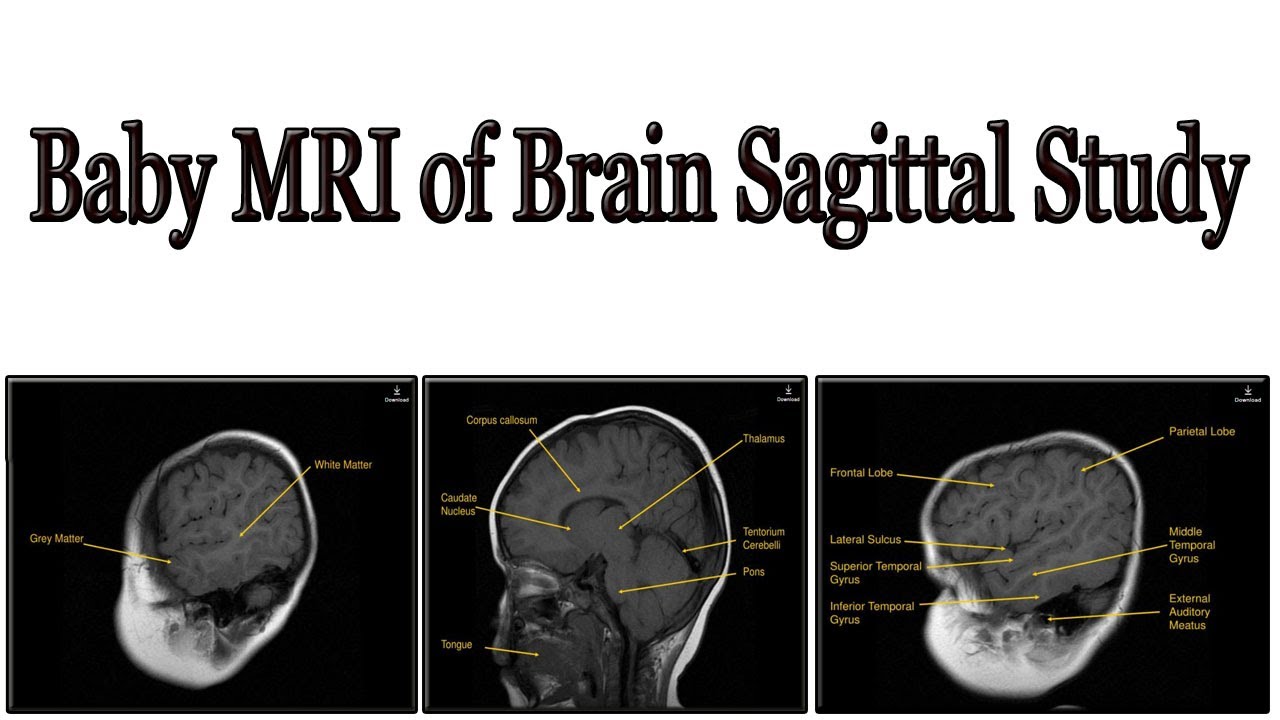 Baby MRI of Brain Study - YouTube