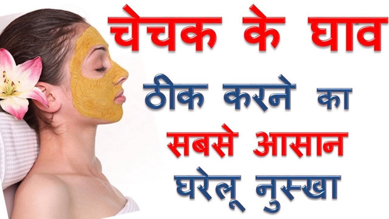 Mata Nikalne Par Chechak Ke Ghav Ka Gharelu ilaj Chicken Pox Smallpox ...