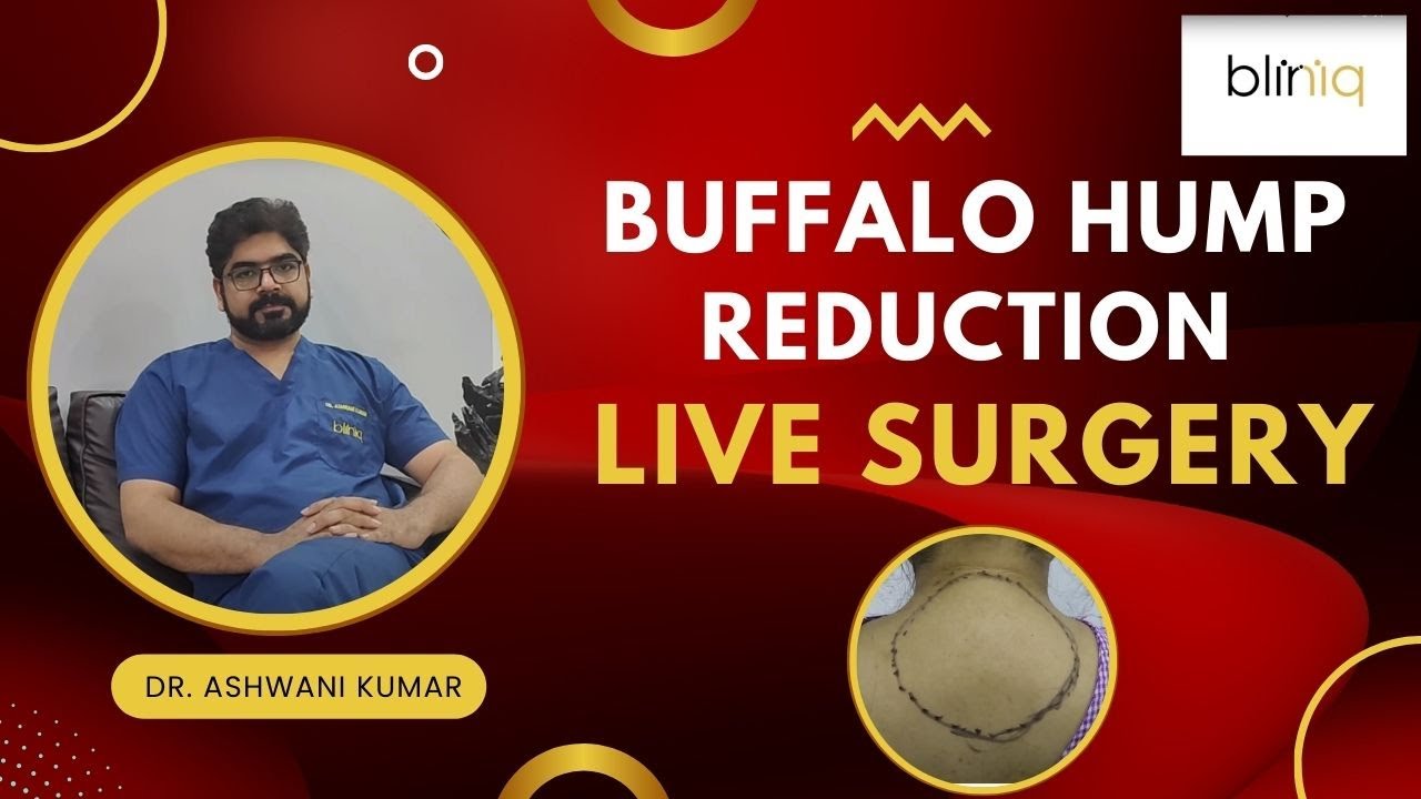 Buffalo Hump Reduction Live Surgery | Liposuction Procedure | How to ...