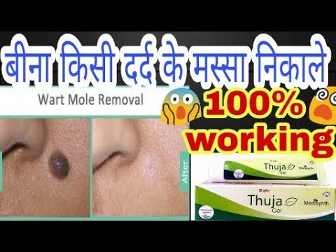 Thuja cream Review | Remove warts and mole without any pain - YouTube