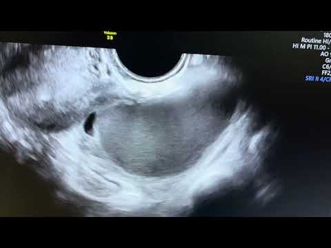 Ultrasound of endometriotic / chocolate cyst - YouTube