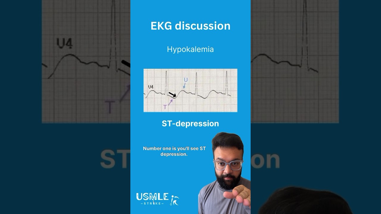Hypokalemia and EKG Changes: Understanding ST Depression, T Wave ...