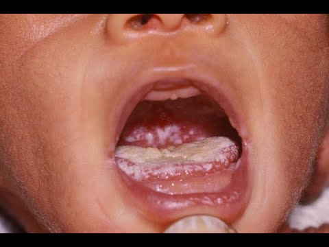 Madaa’uu afaanii fangasiin dhufu (Oral candidiasis)!