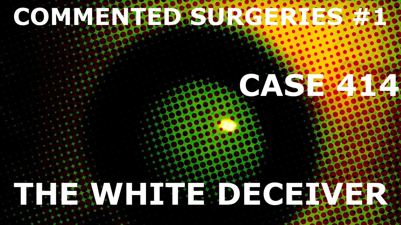 COMMENTED SURGERIES #1 CASE 414 THE WHITE DECEIVER - YouTube