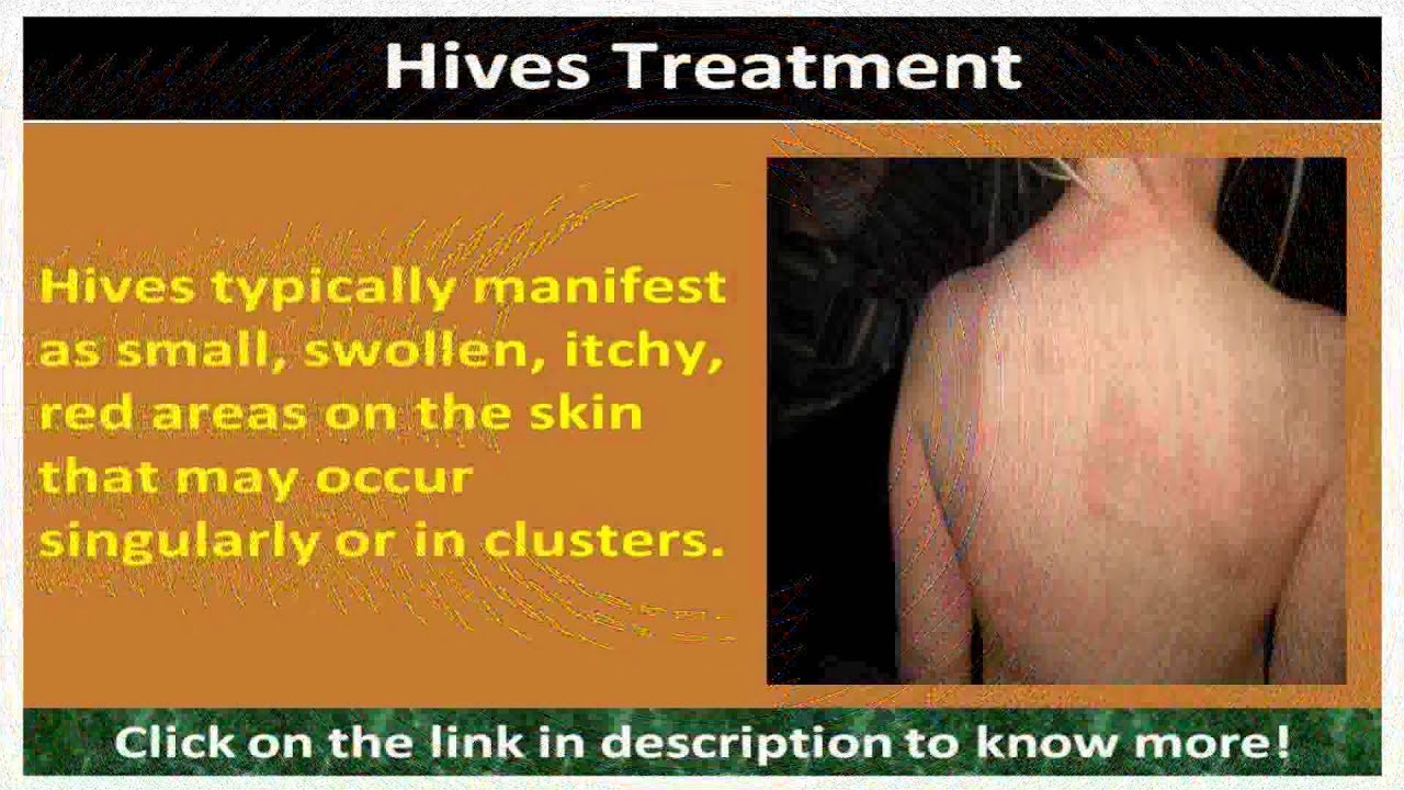 hives symptoms and treatment - YouTube