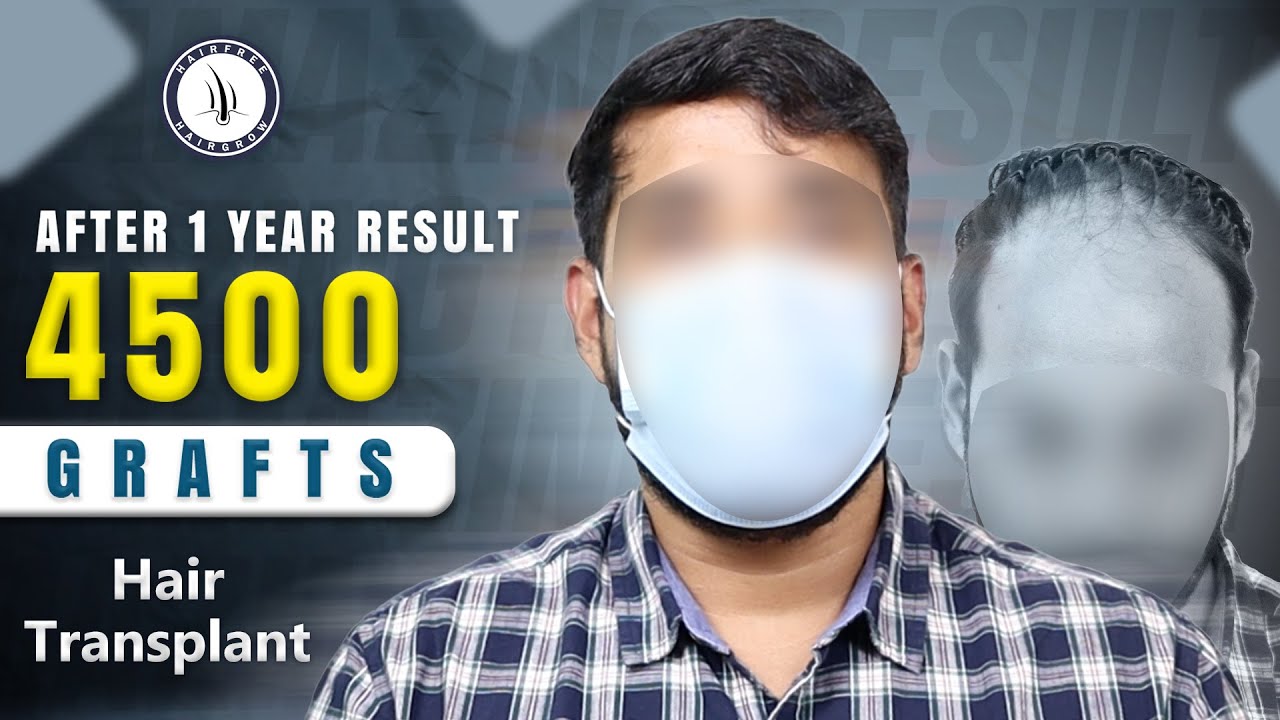 The TRUTH About NW4 Vertex Hair Transplant 4500 Grafts FUE Revealed ...