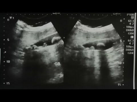Stones In GB ( Ultrasound appearance) - YouTube
