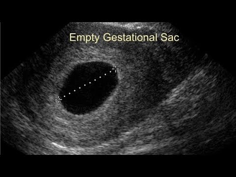 I will talk about yolk sac gestational sac and empty sac in ultrasound ...