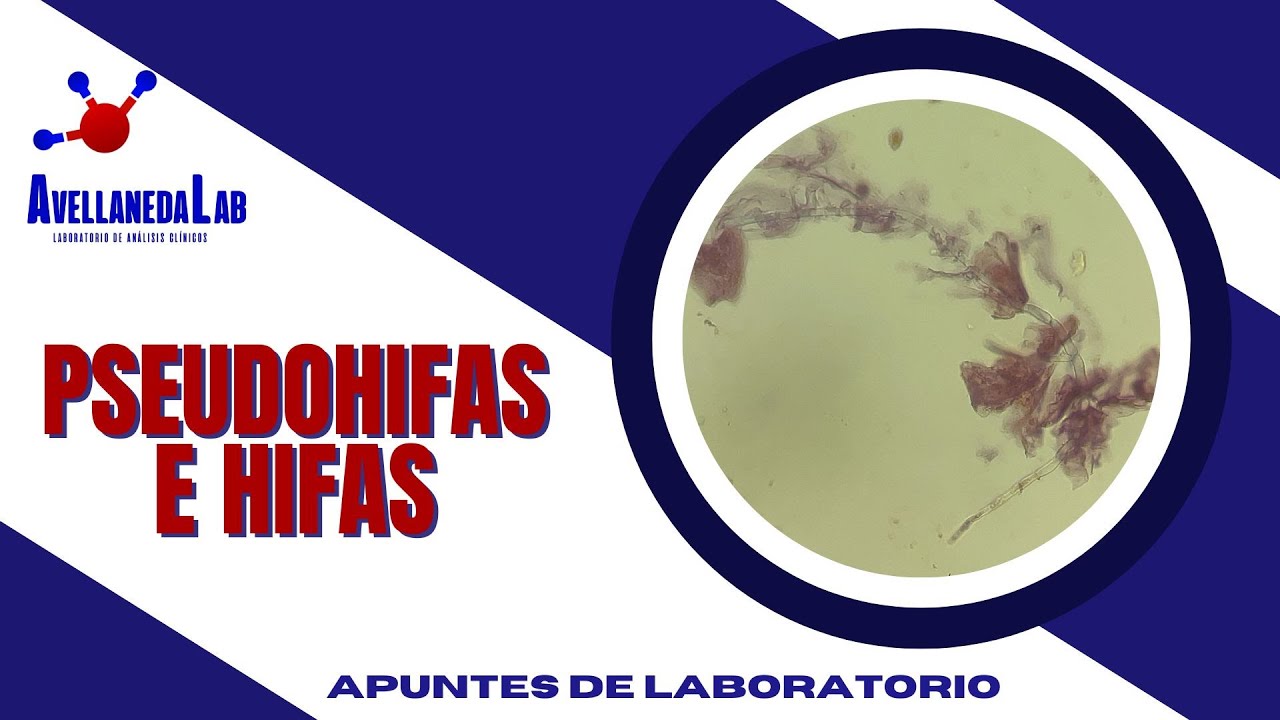 ¿COMO SE VEN LAS PSEHUDOHIFAS E HIFAS EN UNA MUESTRA DE ORINA? - YouTube