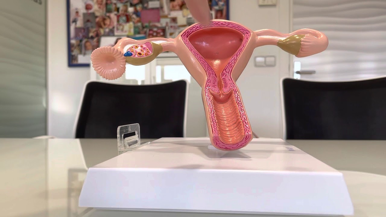 ¿Cómo se coloca un DIU? - YouTube