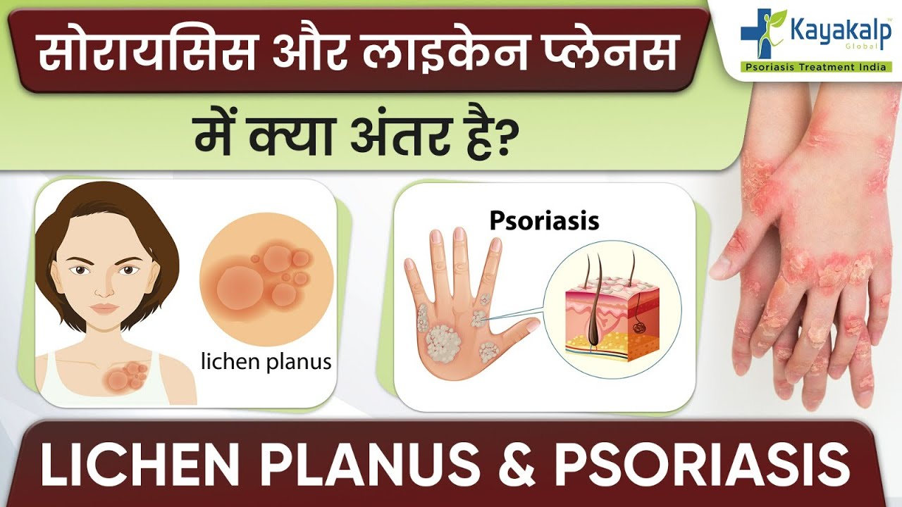 Psoriasis और Lichen Planus मैं क्या अंतर है? | Psoriasis VS Lichen ...