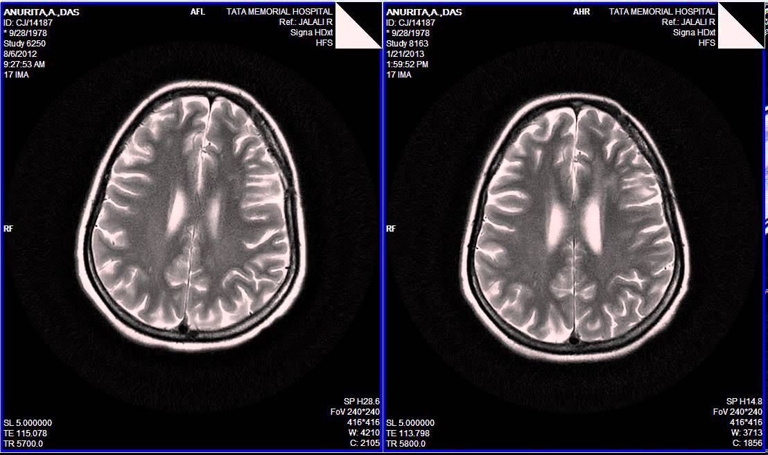 Ax T2 Propeller - Left(02-Aug-2012) Right (21-Jan-2013) - YouTube