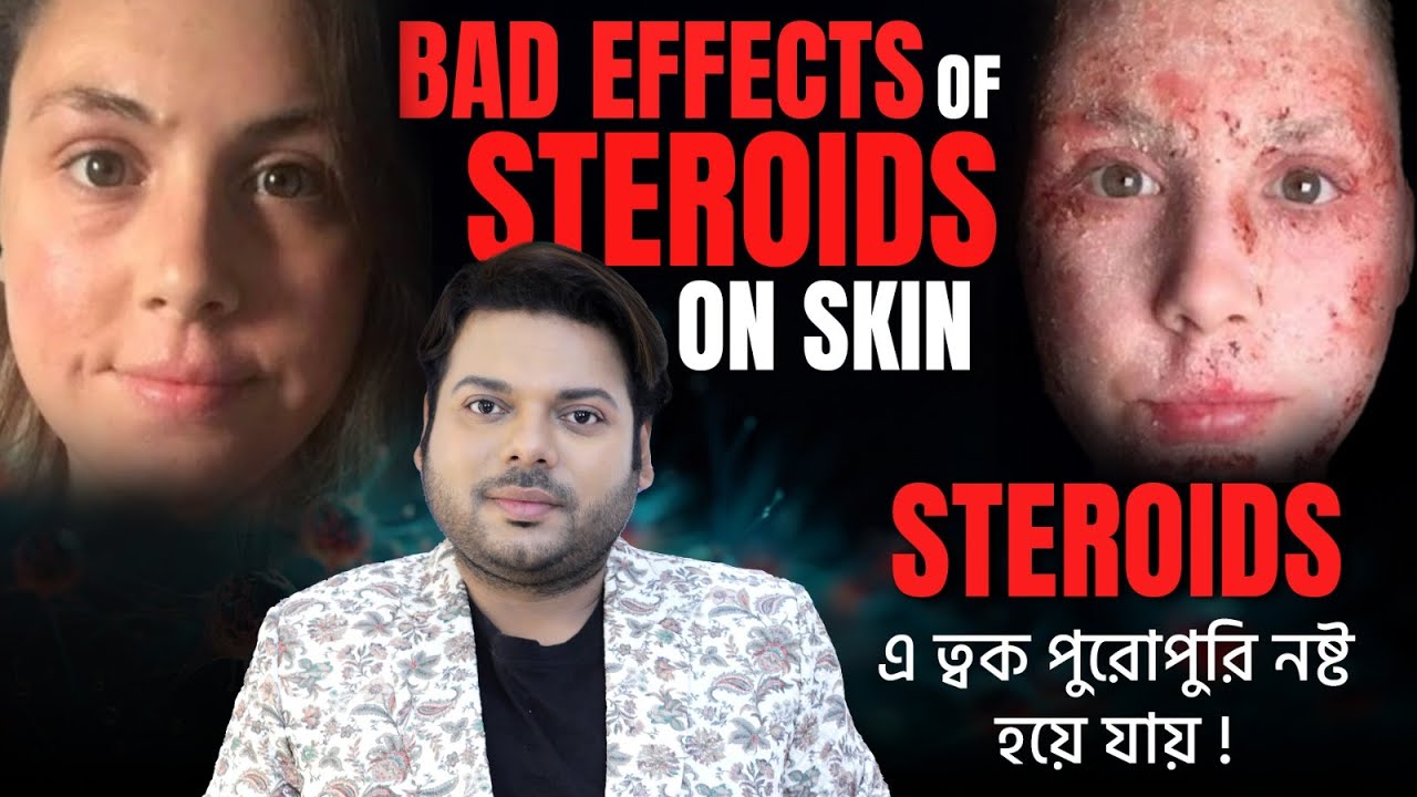 Bad effects of steroids on skin I Steroids এ ত্বক পুরোপুরি নষ্ট হয়ে ...