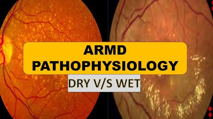 Dry Vs Wet Macular Degeneration