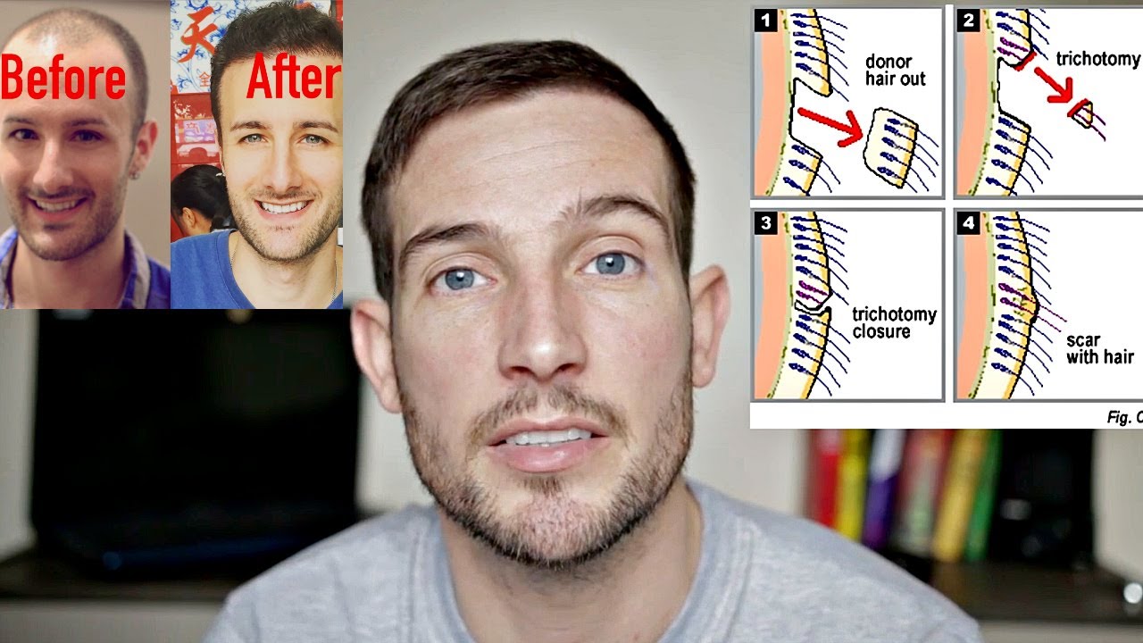 Hair Transplant Transformation - Stu's Story of Surgery in Thailand ...