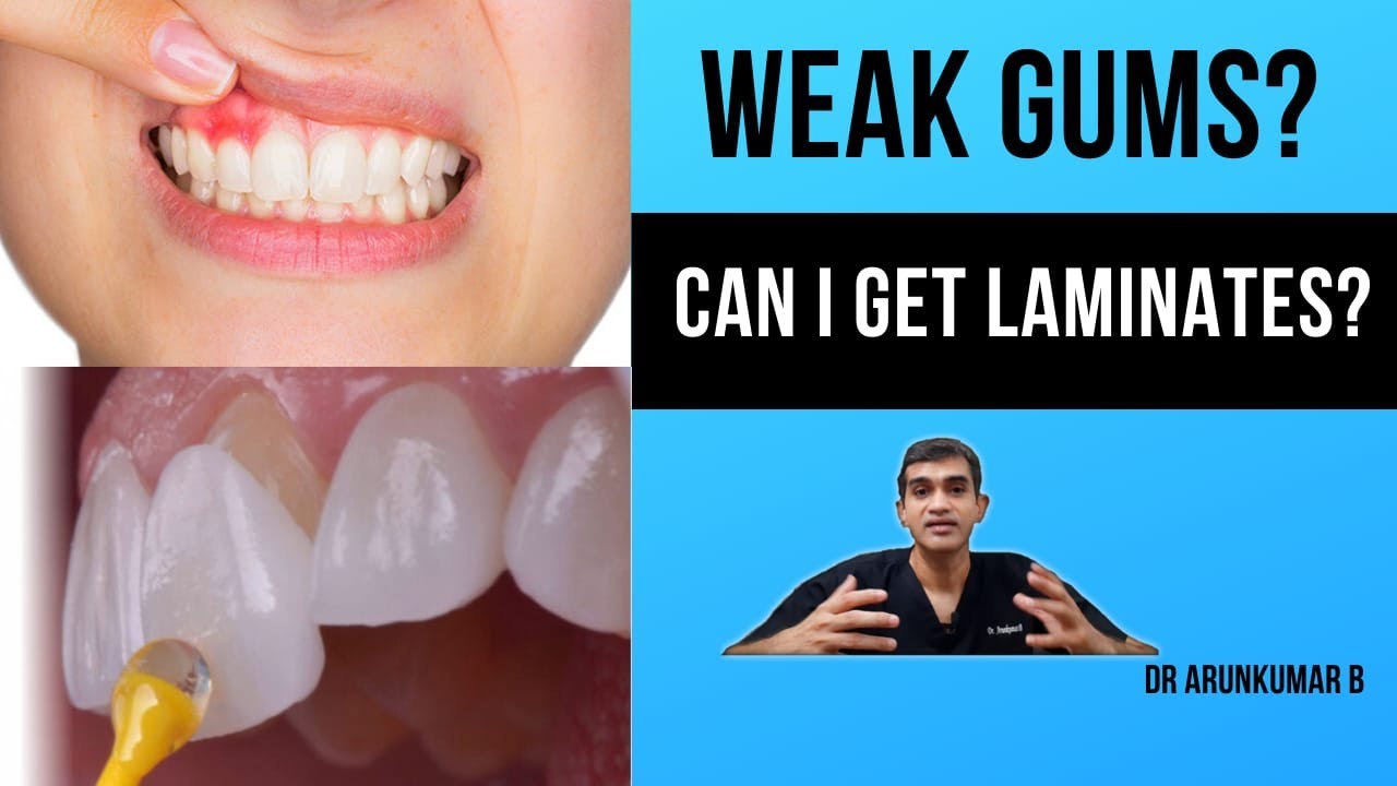 Can Venners be given for badly discoloured Teeth & With Weak Gums? | Dr ...