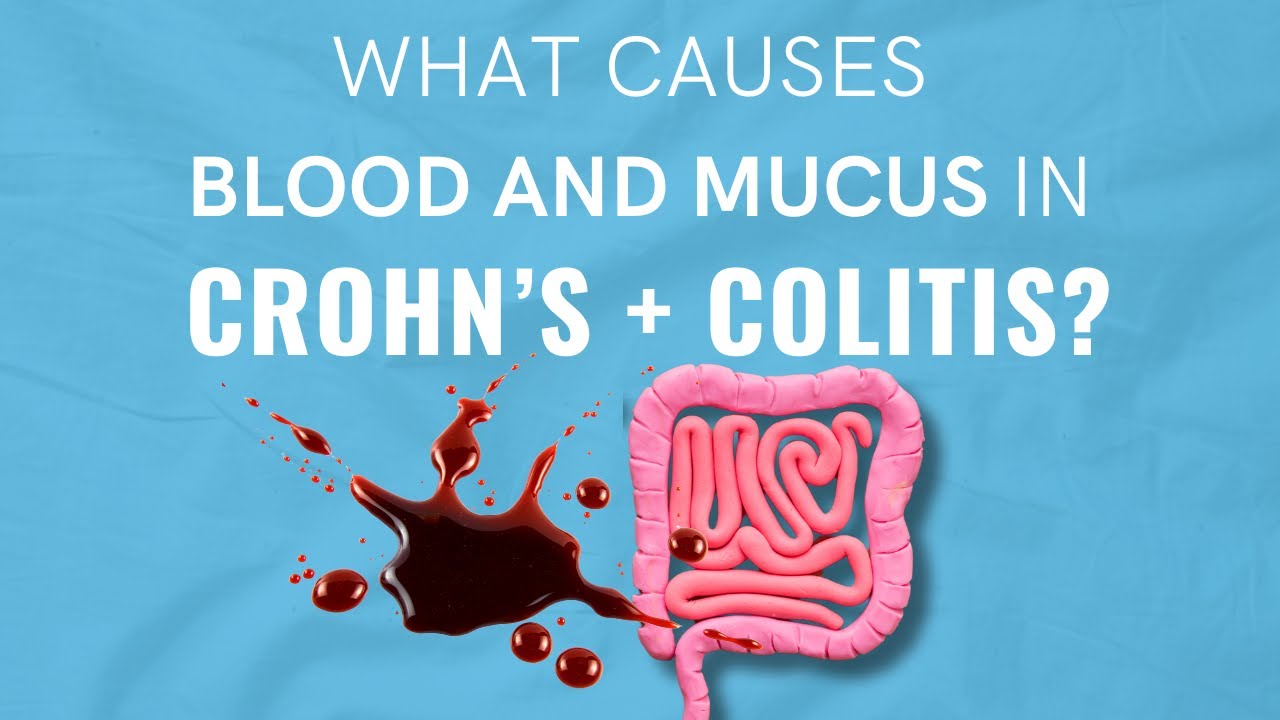 What causes Blood and Mucus with IBD (Crohn's and Colitis)? - YouTube