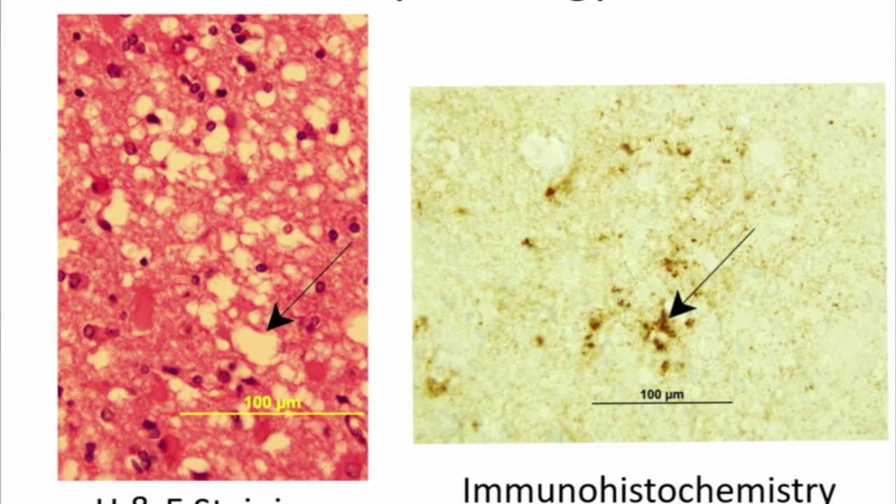 Prion Disease/CJD (Creutzfeld-Jakob Disease) Basics - Brian Appleby ...