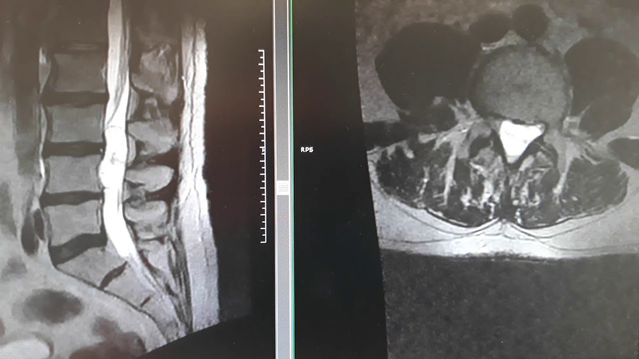 Tumor en la columna lumbar sintomas. Tumor intradural. - YouTube