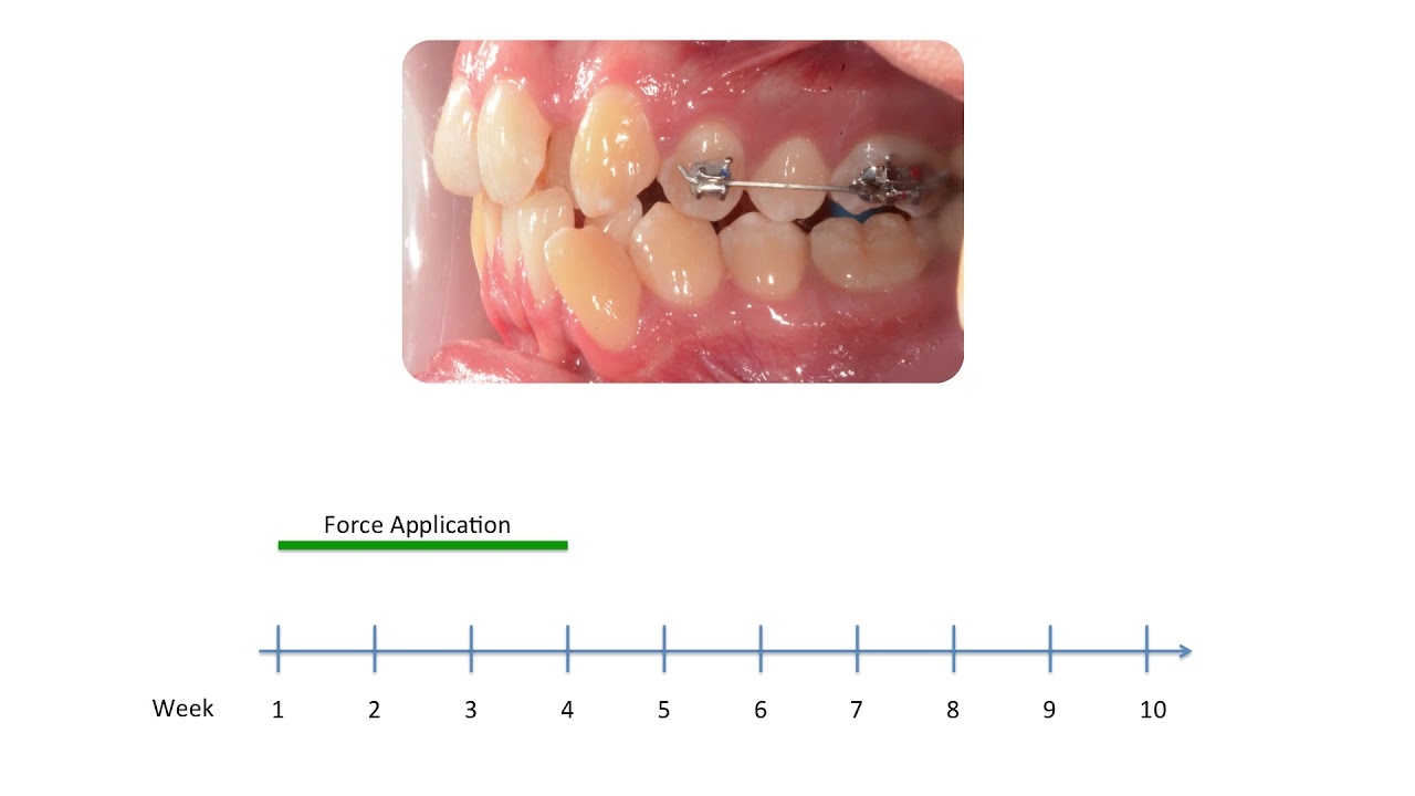 Physical properties of root cementum: Part 27. Effect of low-level ...