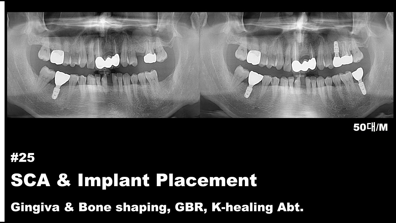 #25 SCA & Implant Placement (Gingiva & Bone shaping, GBR, K-healing Abt ...