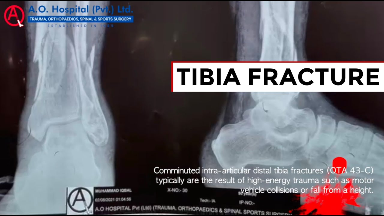 Comminuted Tibia Fracture - YouTube