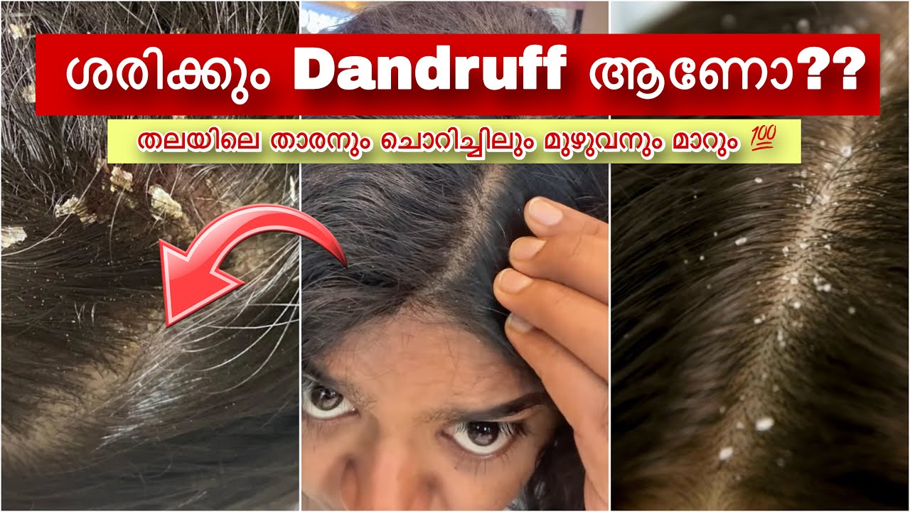 Real താരൻ മാറാൻ ഇത് മാത്രം മതി! How To Remove DANDRUFF From HAIR at ...