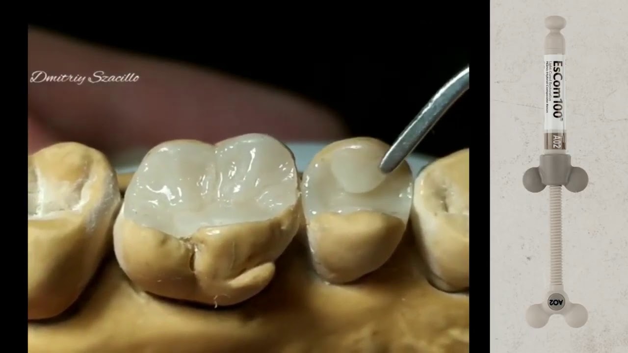 Composite Inlay Technique - YouTube