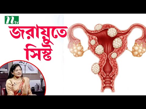 ওভারিয়ান সিস্ট কী? এর লক্ষণ ও উপসর্গ। ডা. জয়শ্রী সাহার পরামর্শ Shastho Protidin স্বাস্থ্য প্রতিদিন