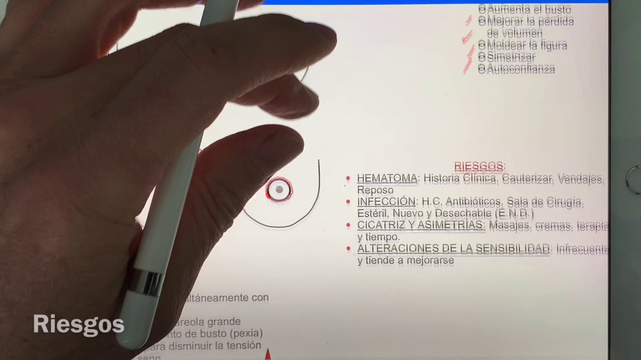 PLASTIA PERIAREOLAR, CORRECCION DE AREOLA, PEXIA PERIAREOLAR VIDEO ...