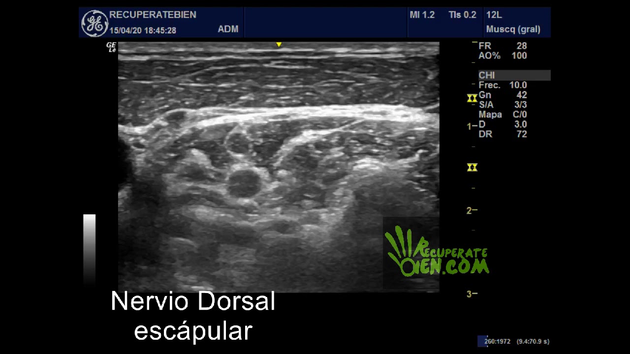 Nervio dorsal escapular - YouTube