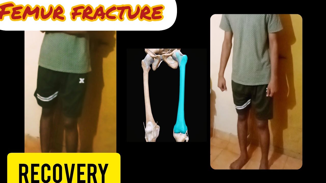 femur fracture recovery in 30 days.|• femur surgery... femur exercise ...