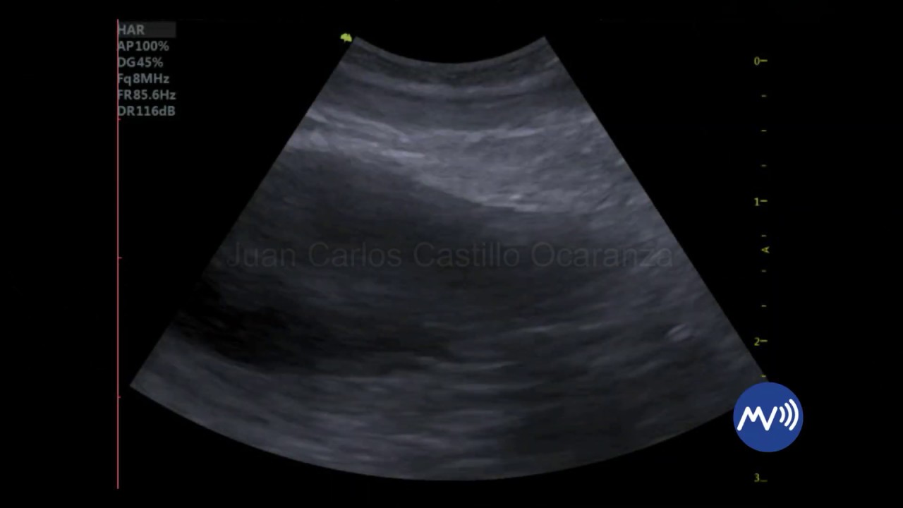 Piometra local y peritonitis - Canino geriatrico - YouTube