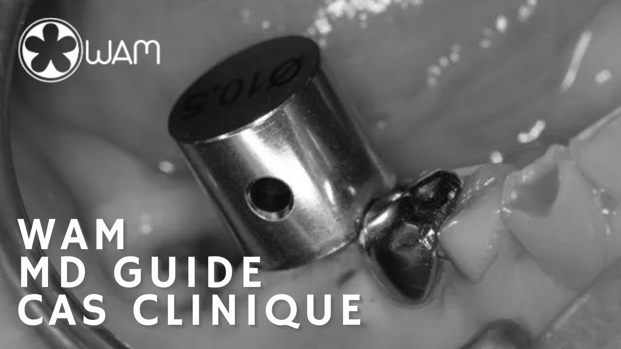 WAM MD Guide - cas cliniques Dr Siadous et Dr Plan - ADF 2013 - YouTube